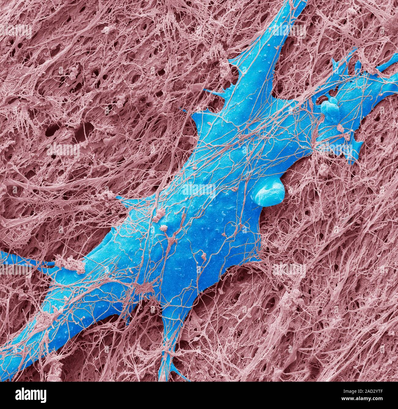 Bone cancer cell. Coloured scanning electron micrograph of an ...