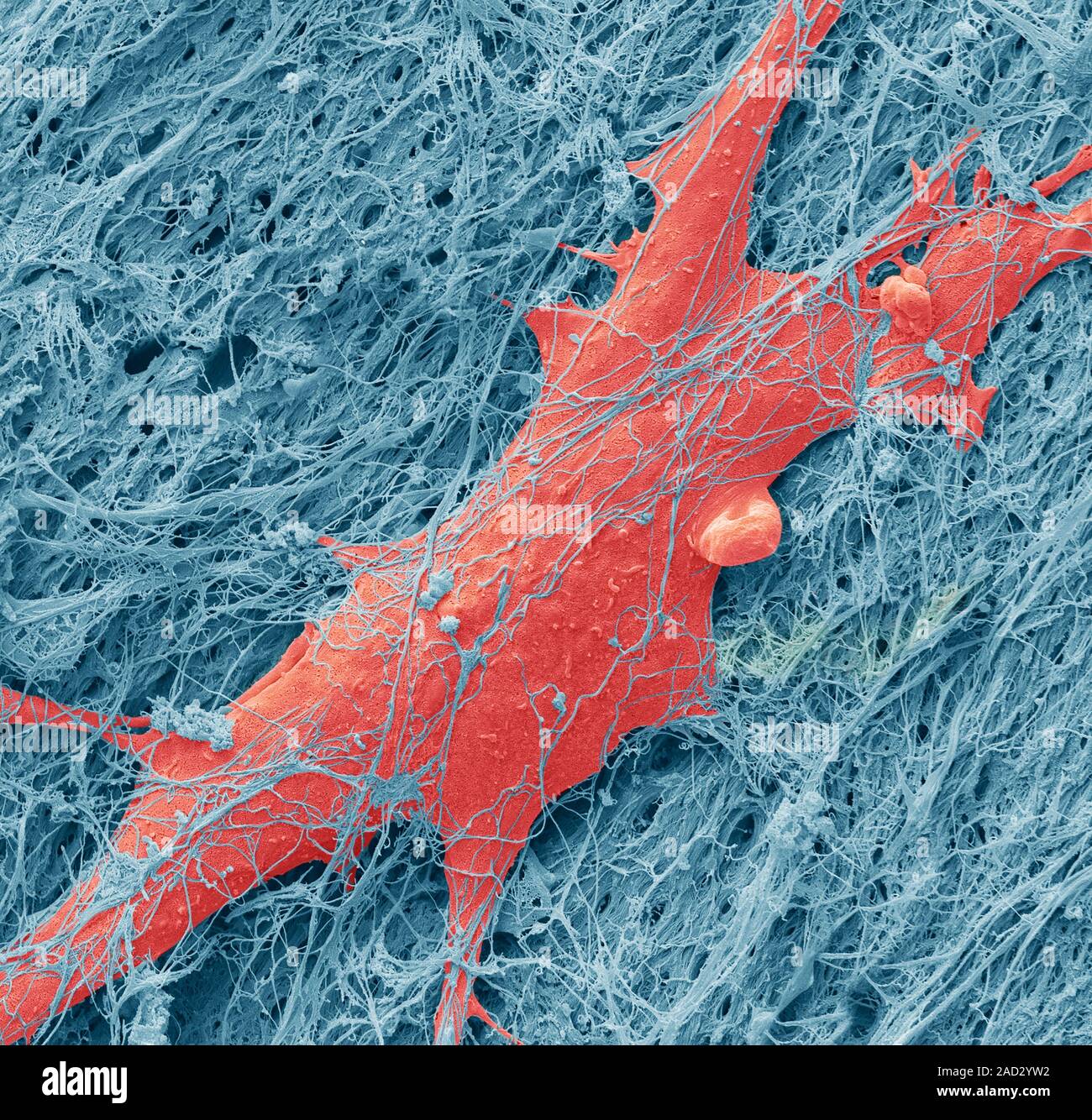 Bone cancer cell. Coloured scanning electron micrograph of an ...