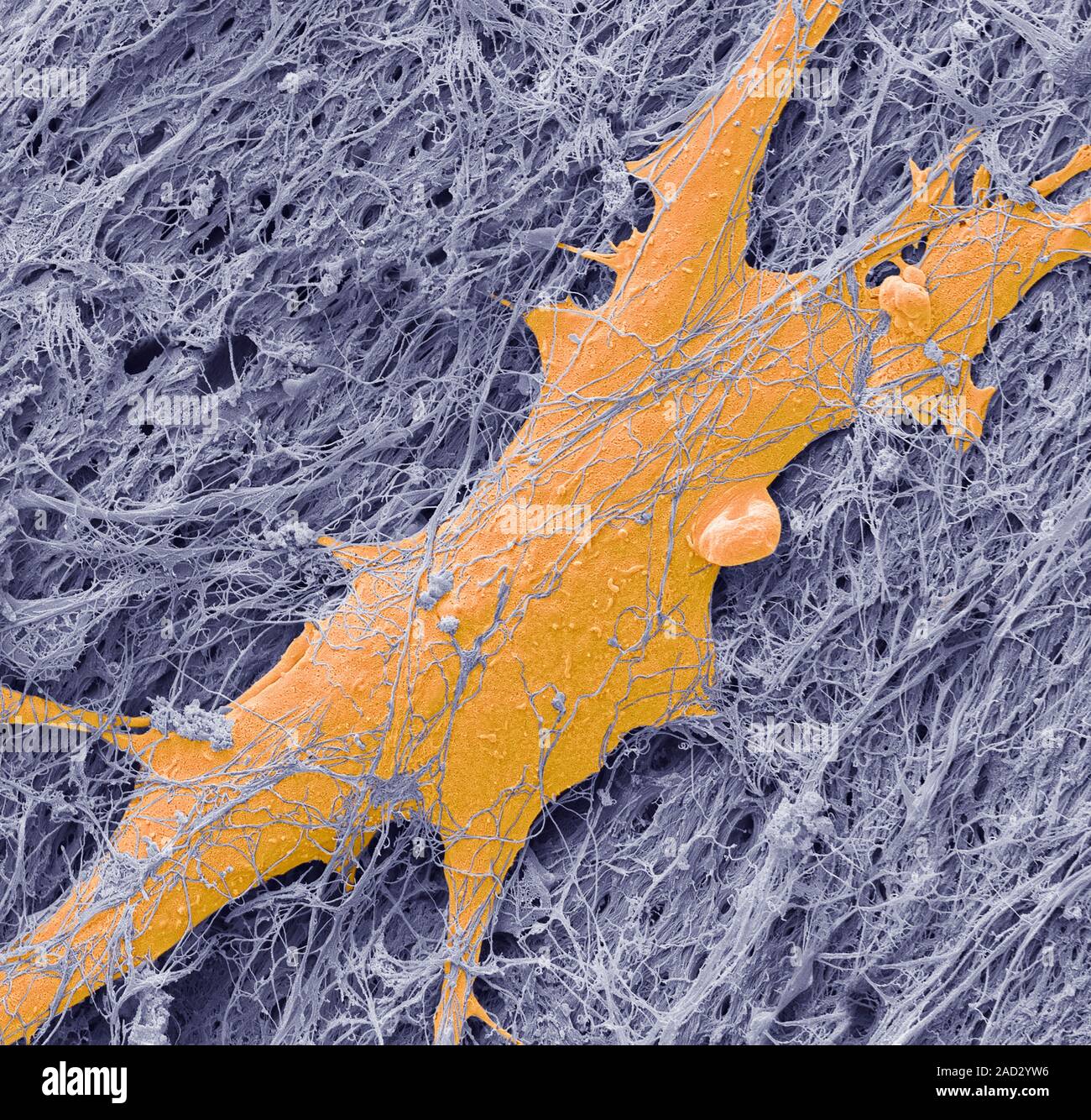 Bone cancer cell. Coloured scanning electron micrograph of an ...