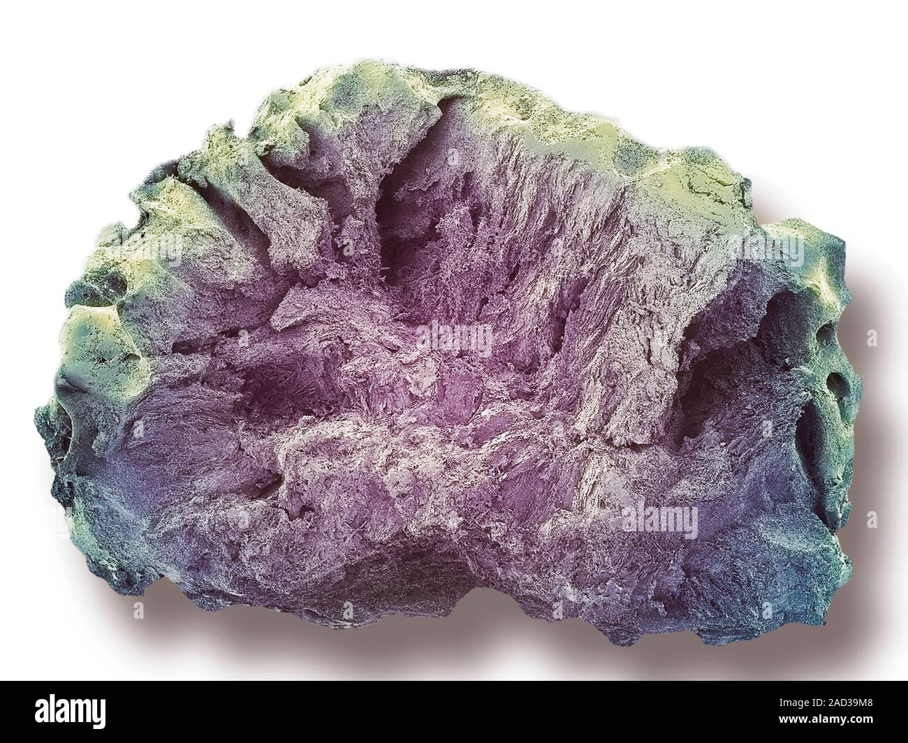 Gallstone. Coloured scanning electron micrograph (SEM) of a fractured ...
