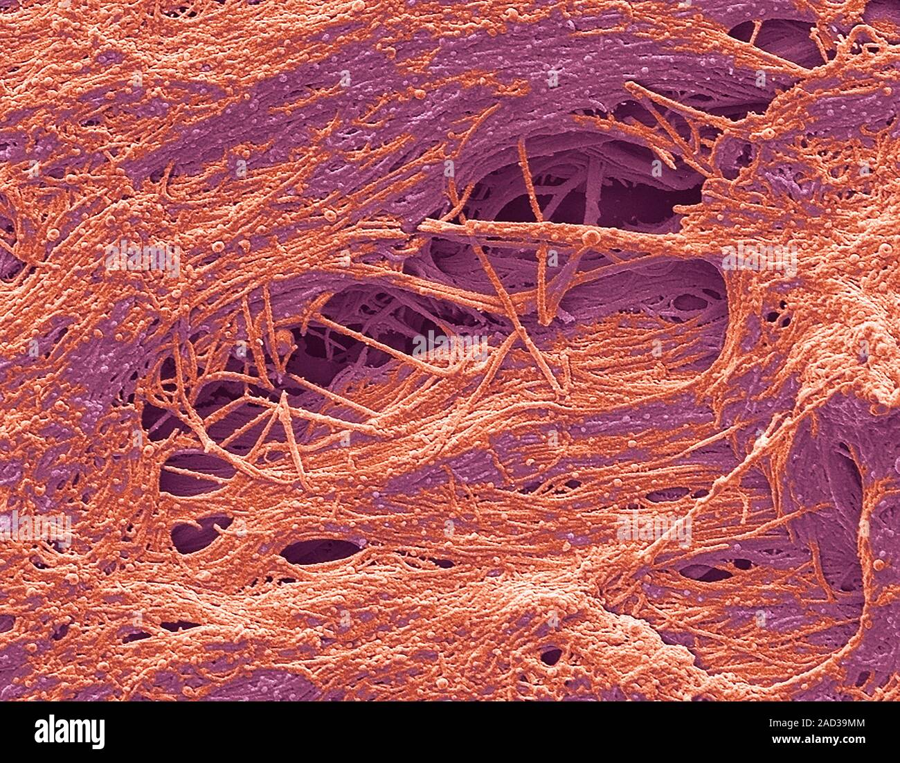 Renal amyloidosis. Coloured scanning electron micrograph (SEM) of amyloid fibers from a patient ...