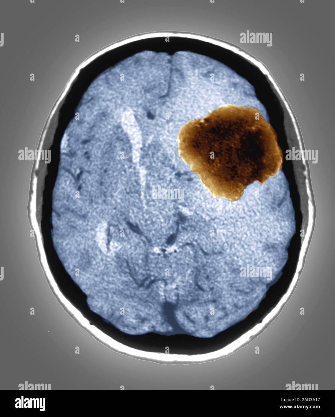 Benign brain tumour. Computed tomography (CT) scan of an axial section ... Benign brain tumour. Computed tomography (CT) scan of an axial section ...