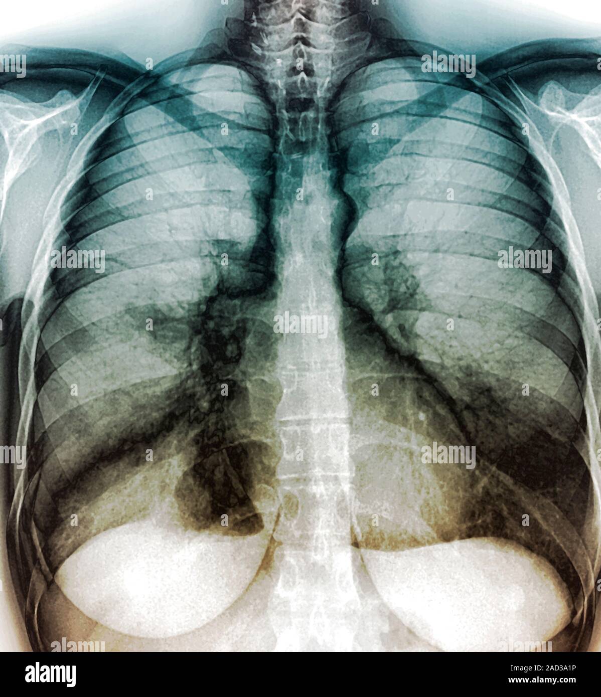 Chest infection. Frontal chest X-ray of a 32-year-old patient with an ...