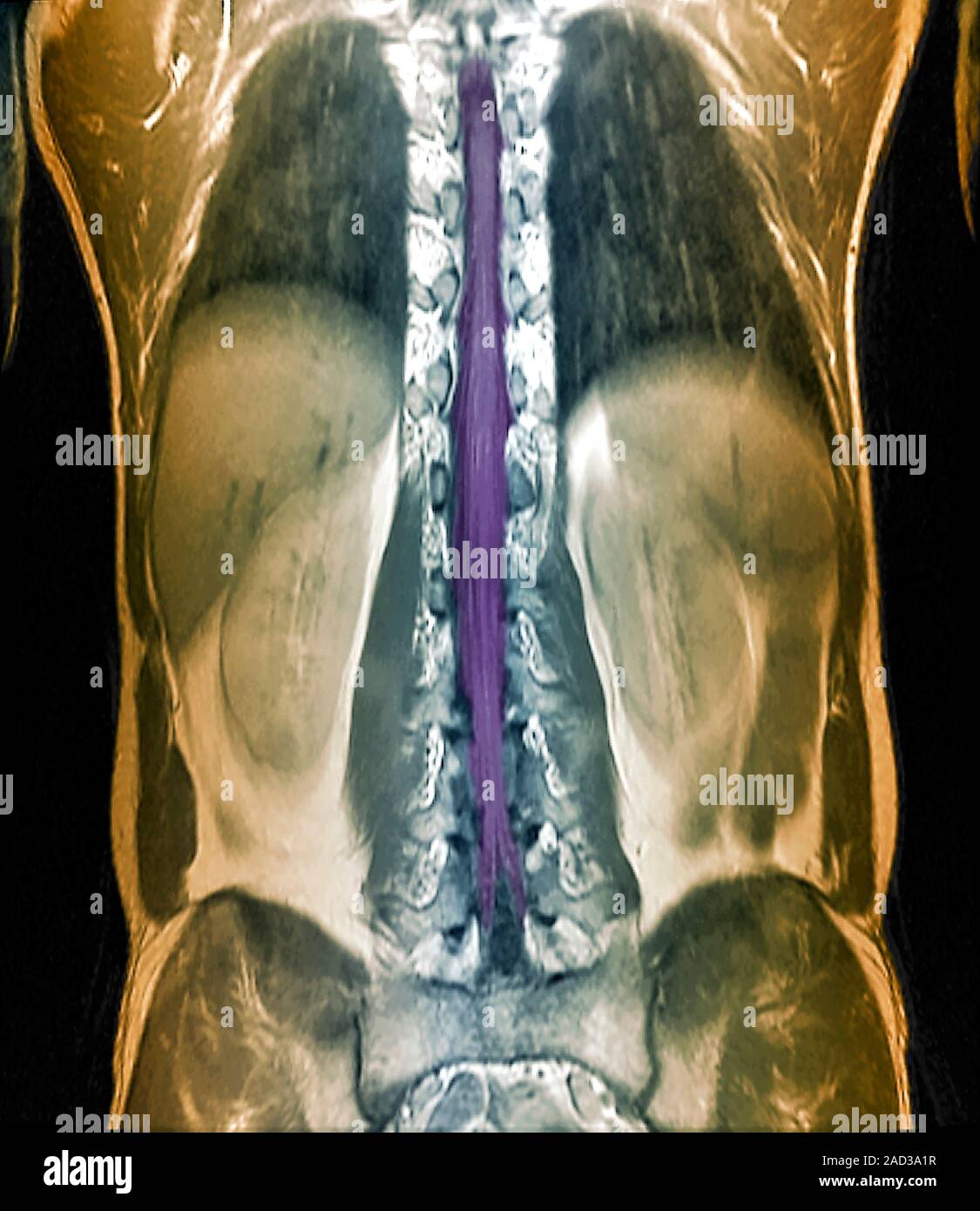 Normal spinal cord. Magnetic resonance imaging scan (MRI) of a section ...