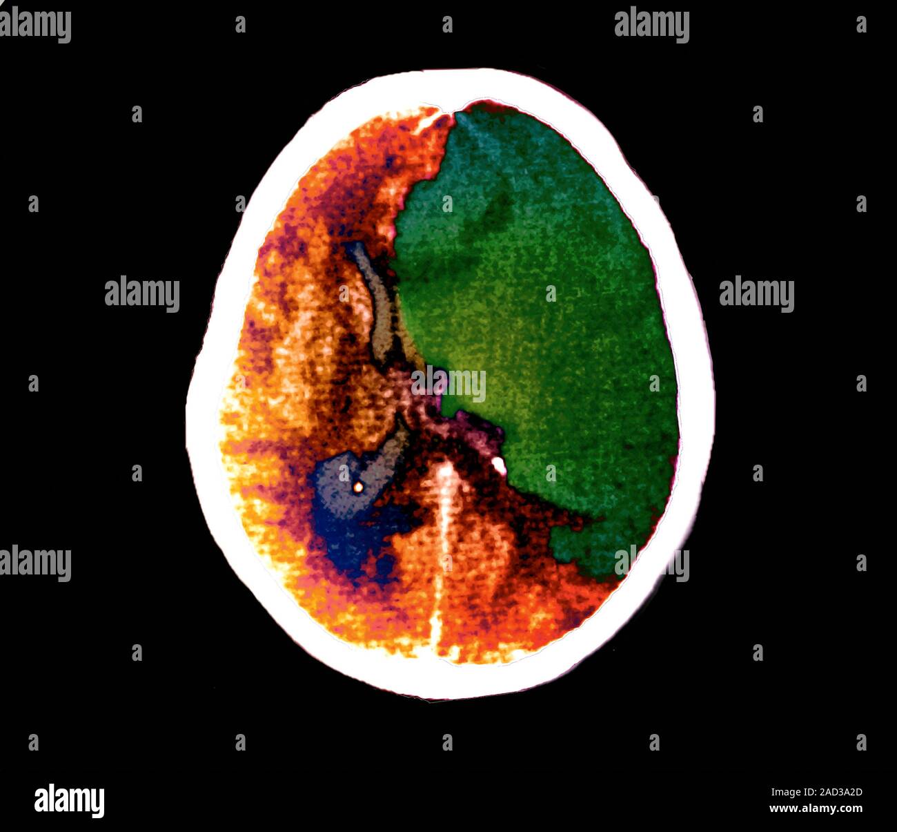 Brain in stroke. Coloured computed tomography (CT) scan of an axial section through the brain of ...