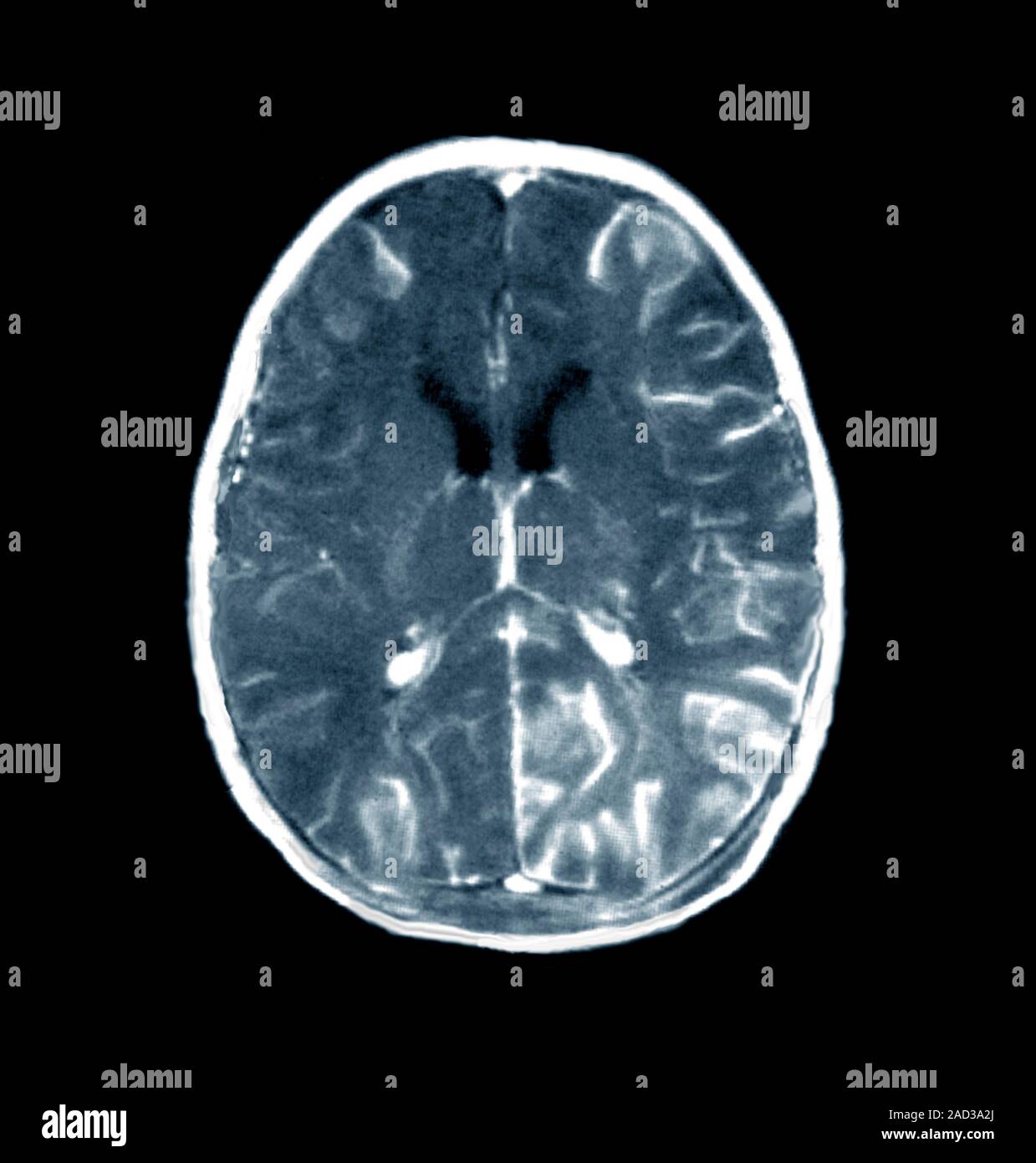 Brain in meningitis. Computed tomography (CT) scan of an axial section through the brain of a 39 ...