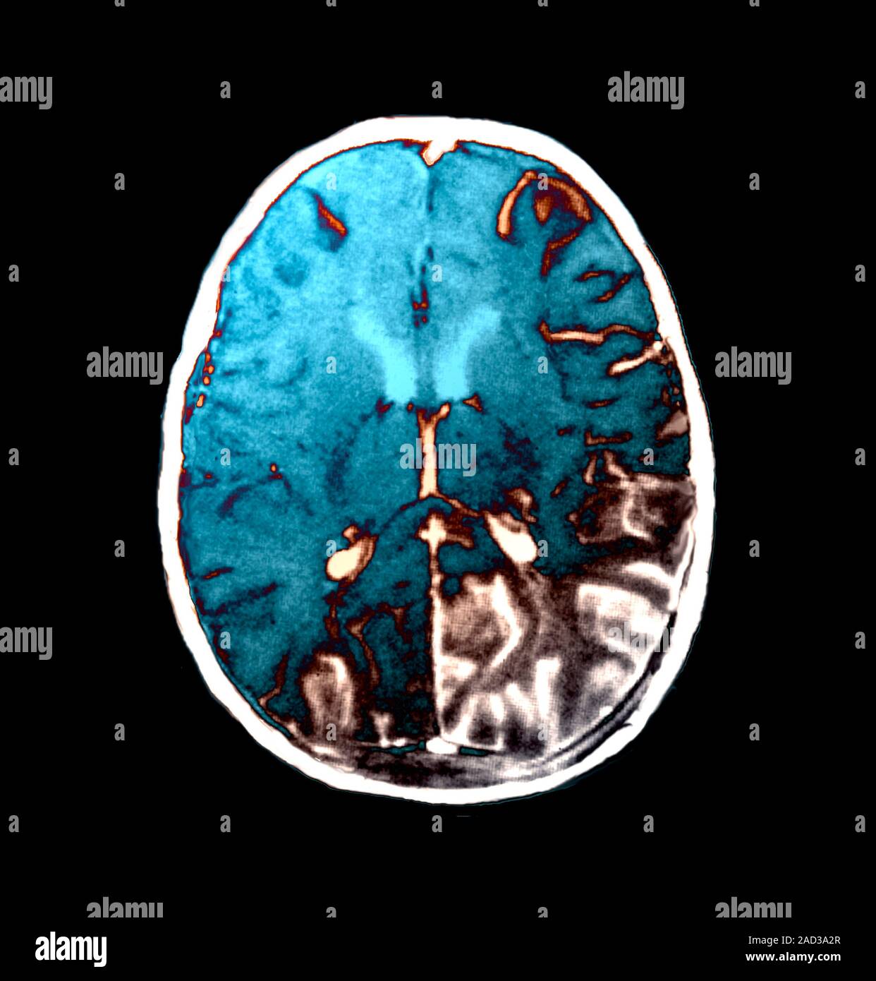 Brain in meningitis. Coloured computed tomography (CT) scan of an axial ...