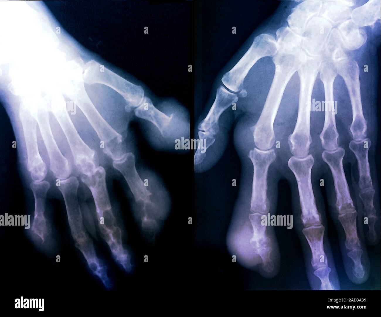 Gout. Coloured X-ray of the hands of a 55-year-old patient with gout ...
