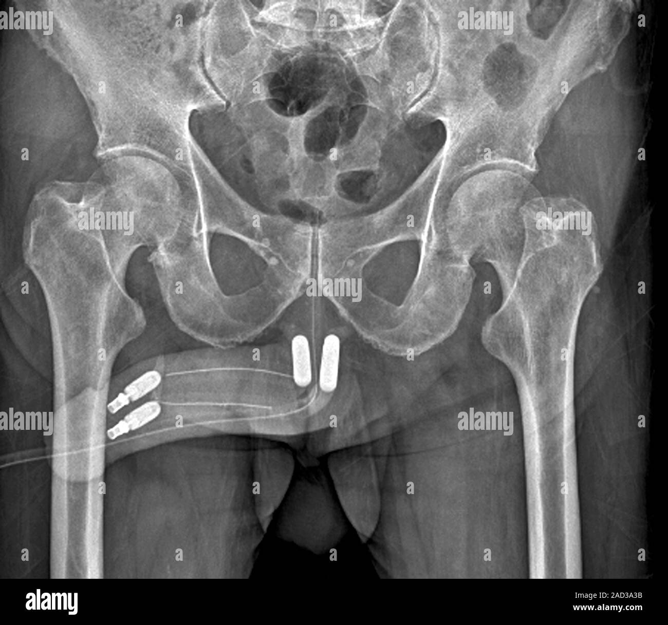 Incontinence implant. Coloured frontal X-ray of the pelvic region of a ...