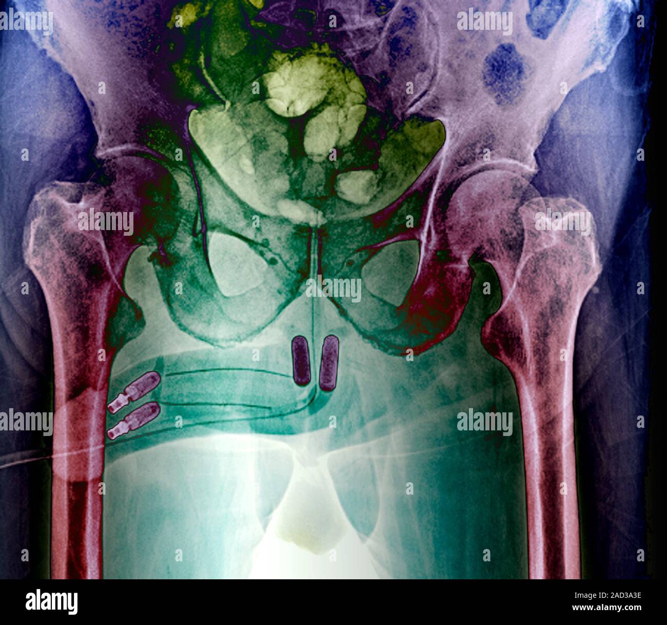 Incontinence implant. Coloured frontal X-ray of the pelvic region of a ...