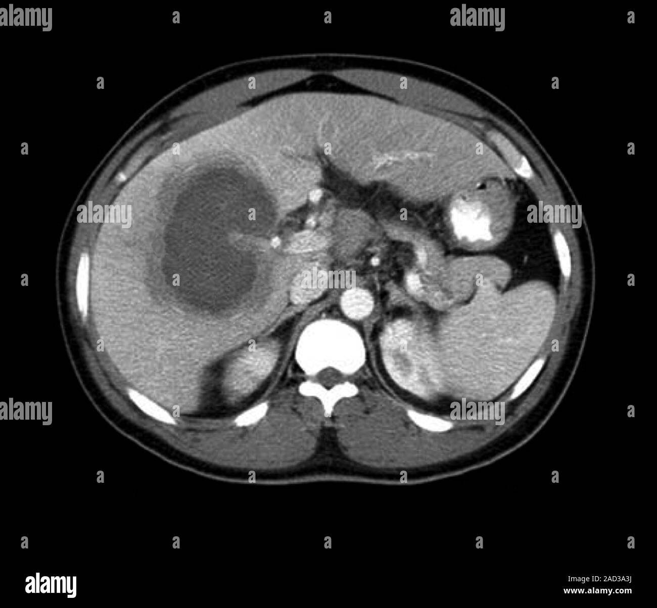 Liver abscess. Computed tomography (CT) scan of an axial section ...