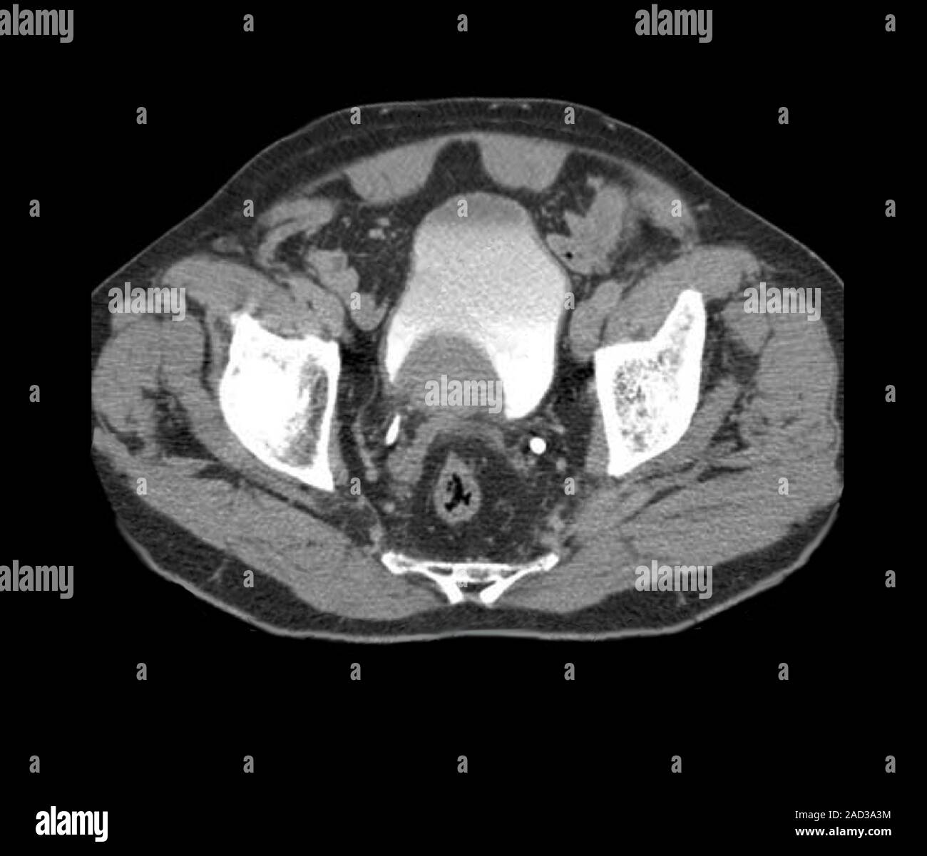 Prostate tumour. Coloured computed tomography (CT) scan of an axial ...