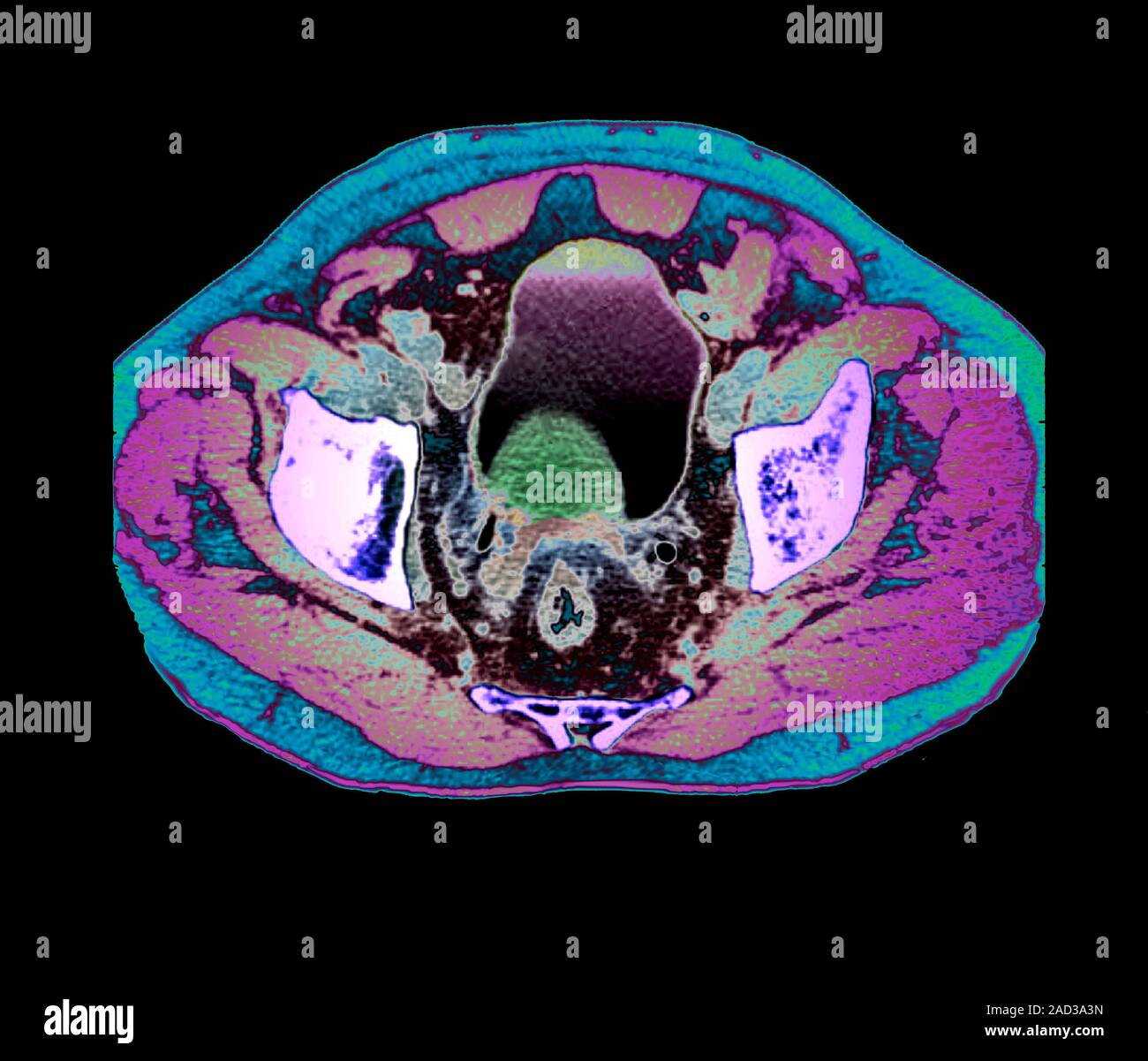 Prostate tumour. Coloured computed tomography (CT) scan of an axial ...