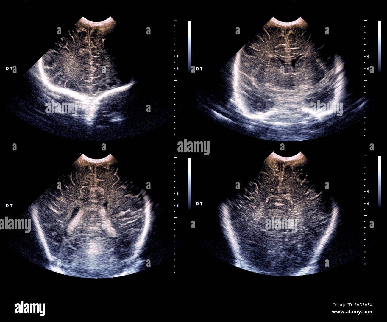 Premature baby normal development. Coloured ultrasound scans of ...