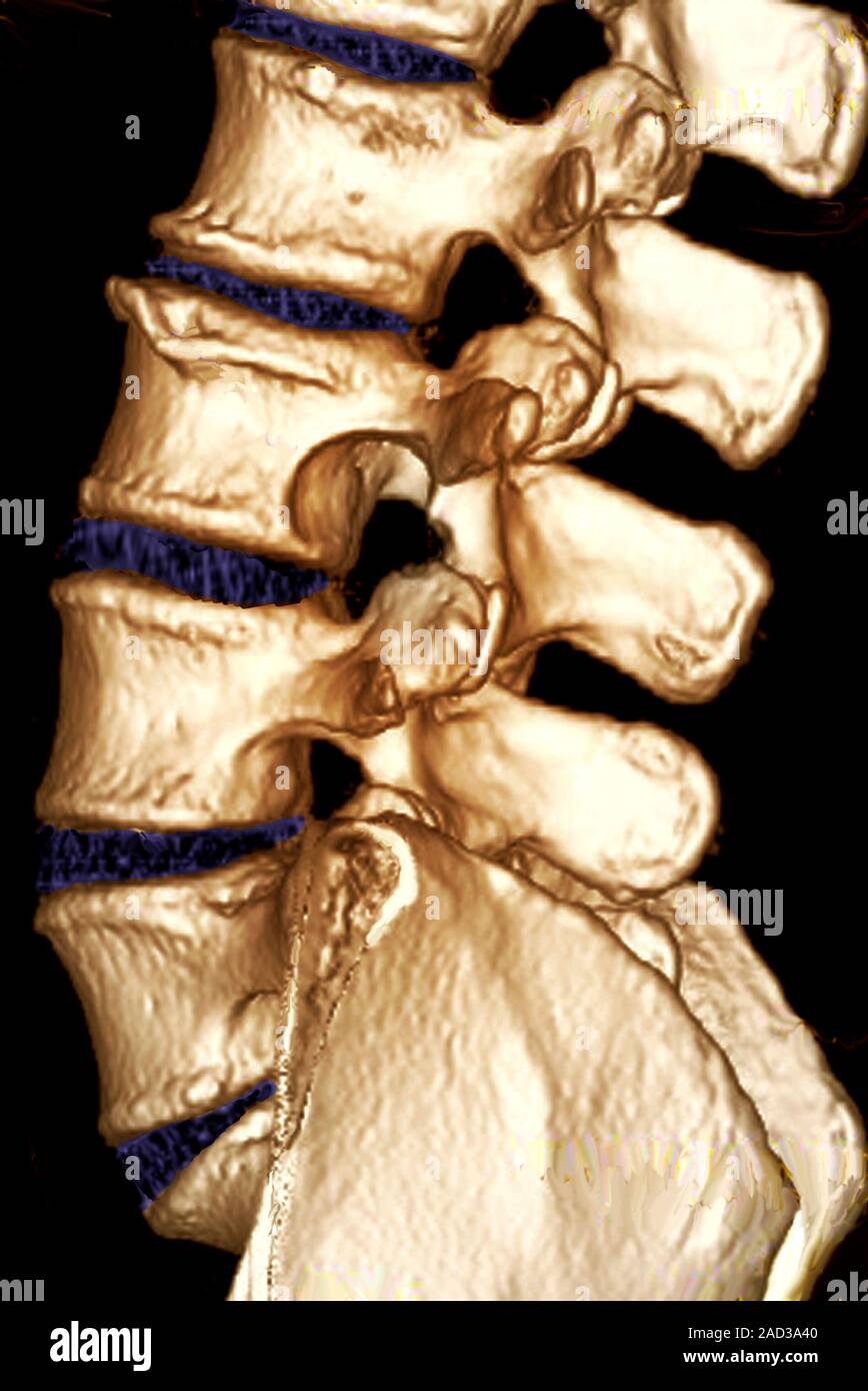 Spinal tumour. Coloured 3D computed tomography (CT) scan of the lumbar ... Spinal tumour. Coloured 3D computed tomography (CT) scan of the lumbar ...