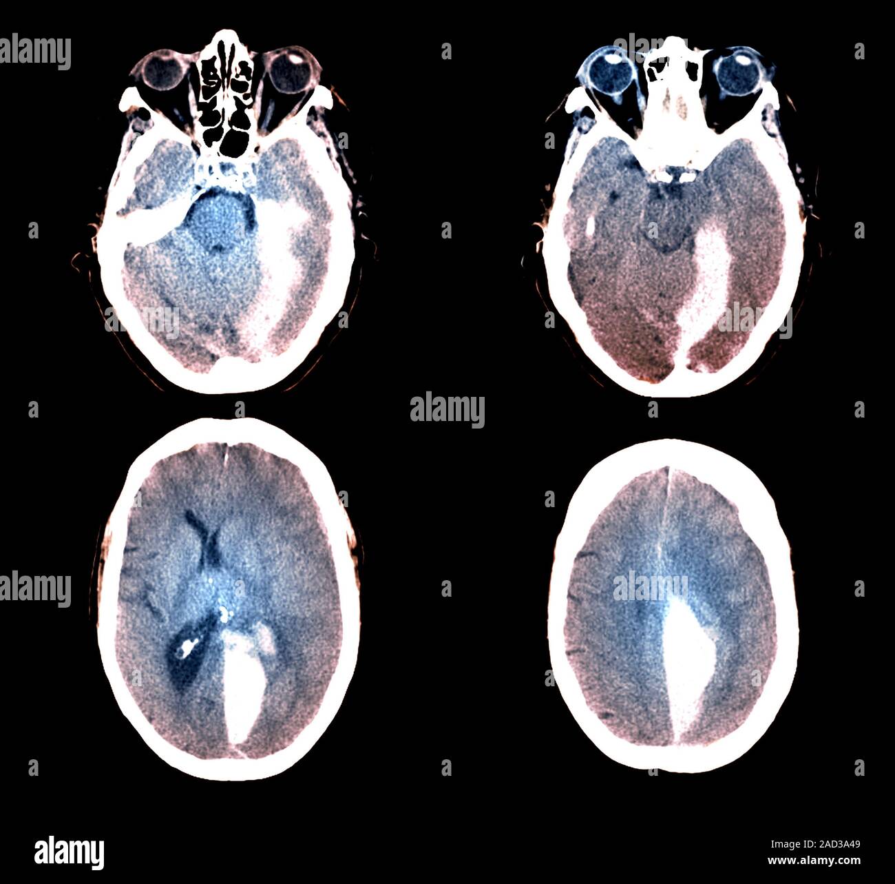 Brain haemorrhage following fall. Coloured computed tomography (CT) scans of sections through ...
