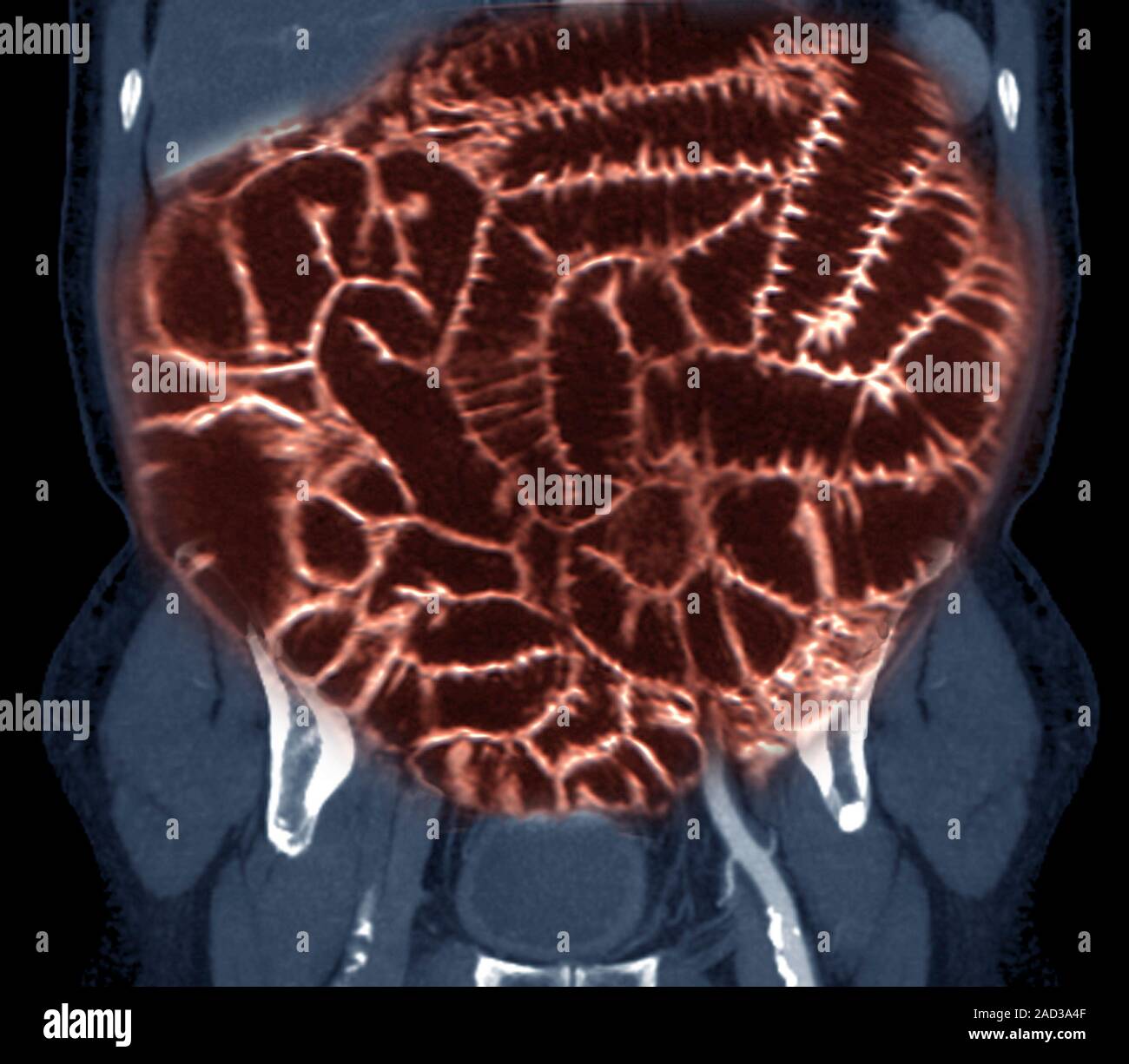 Normal intestines in obese patient. Coloured magnetic resonance imaging ...