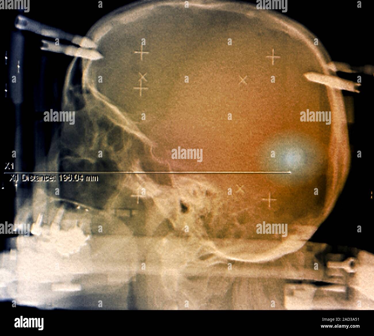 Stereotactic biopsy of brain tumour. Coloured computed tomography (CT ...