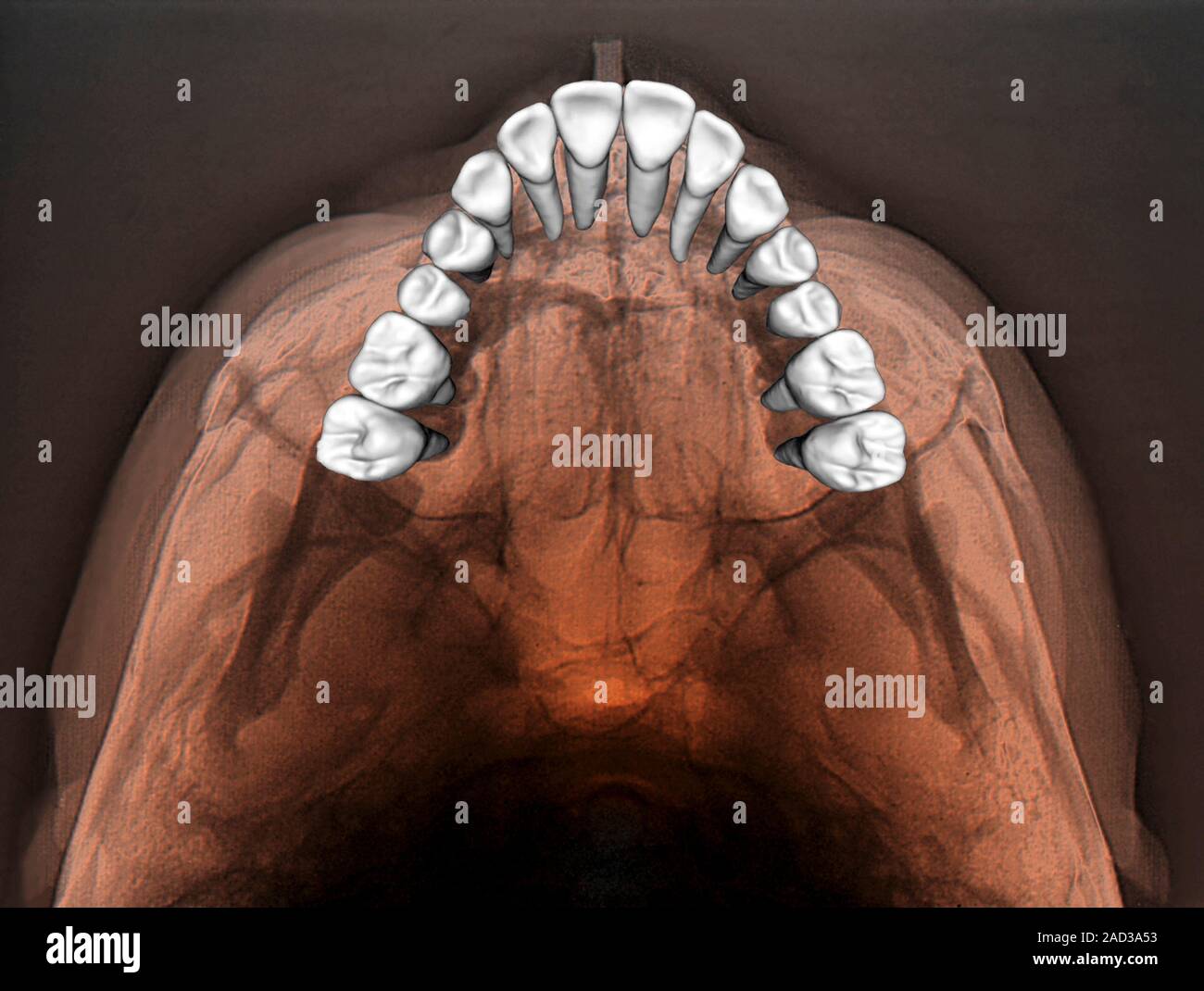 Normal teeth. Coloured 3D cone beam computed tomography (CBCT) scan of ...