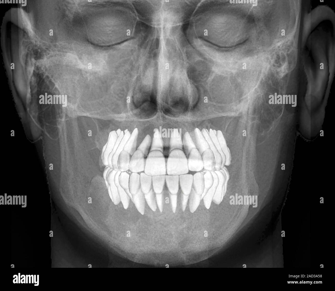 Normal teeth. 3D cone beam computed tomography (CBCT) scan of the ...