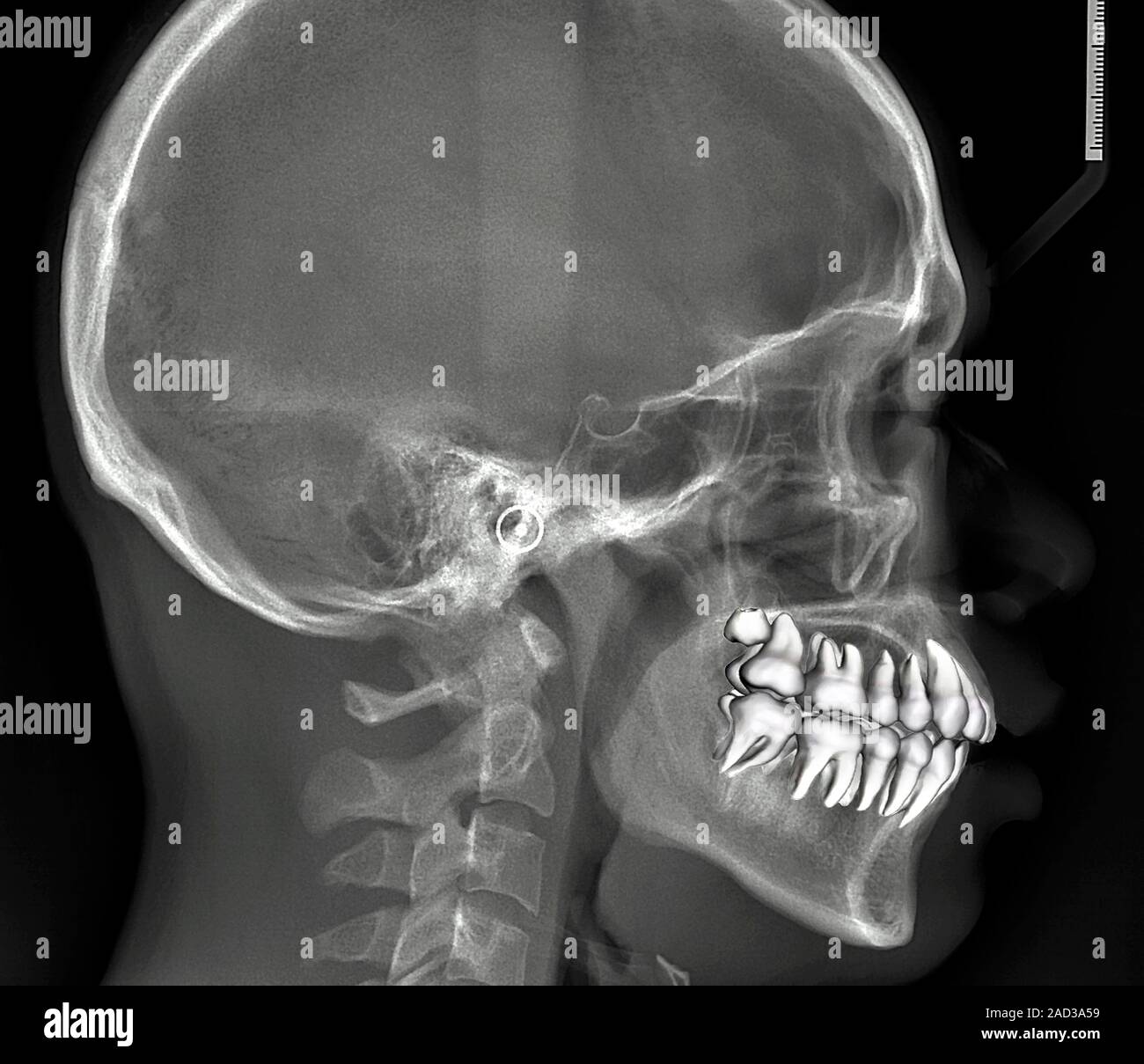 Normal teeth. 3D cone beam computed tomography (CBCT) scan of the ...