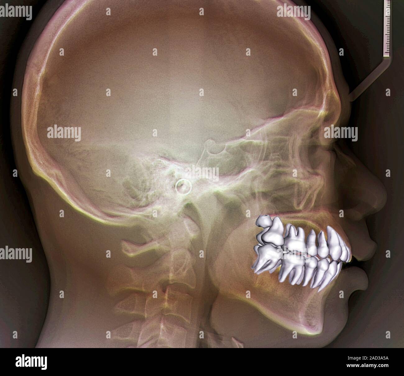 Normal teeth. Coloured 3D cone beam computed tomography (CBCT) scan of ...