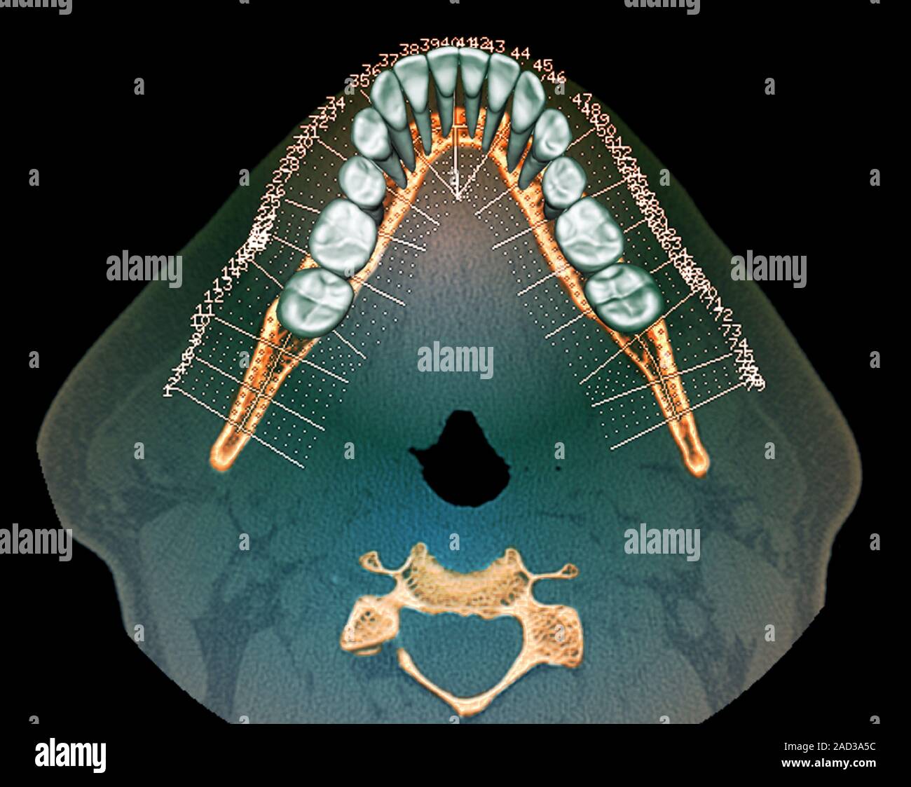 Normal teeth. Coloured 3D cone beam computed tomography (CBCT) scan of ...