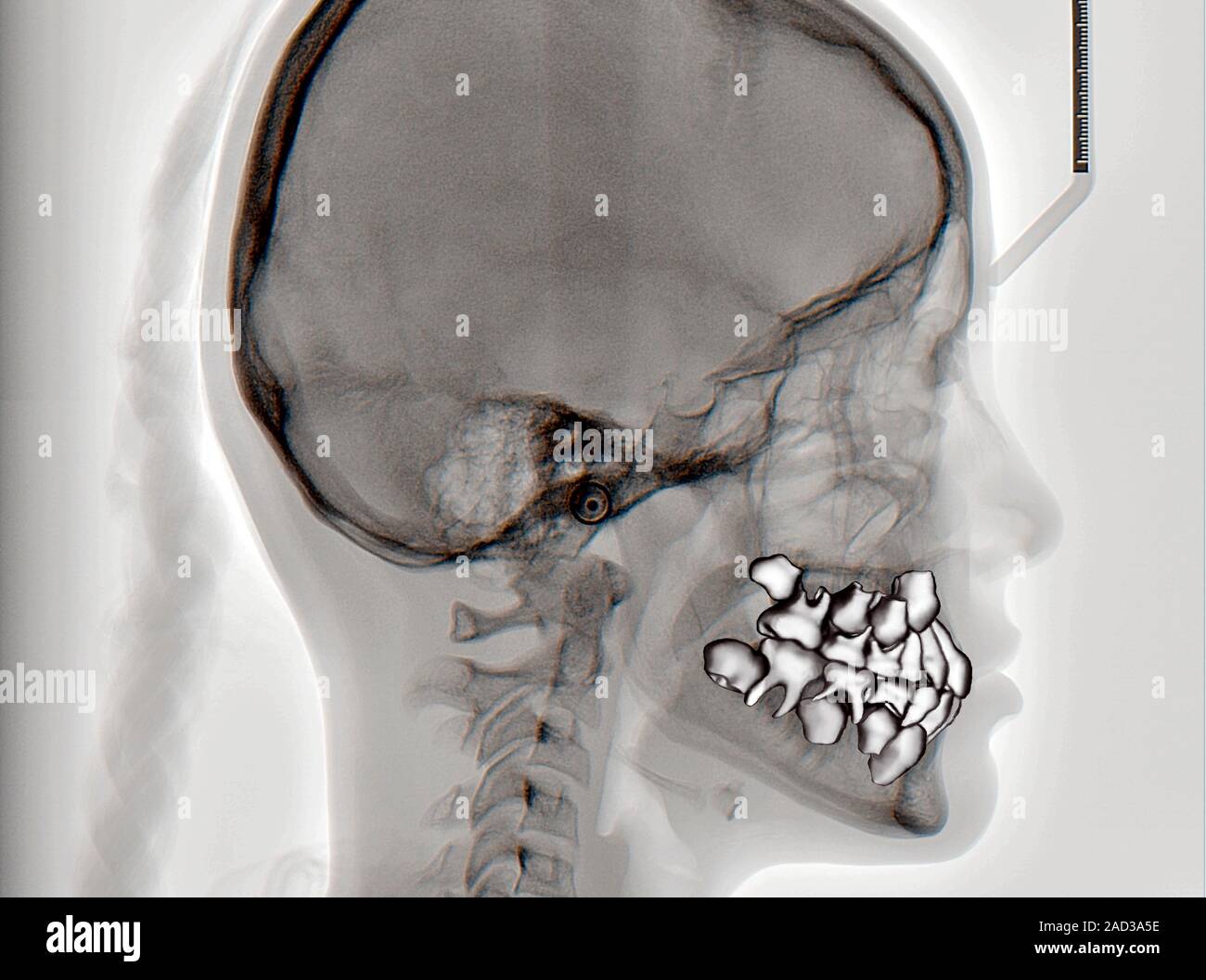 Normal teeth. 3D cone beam computed tomography (CBCT) scan of the ...
