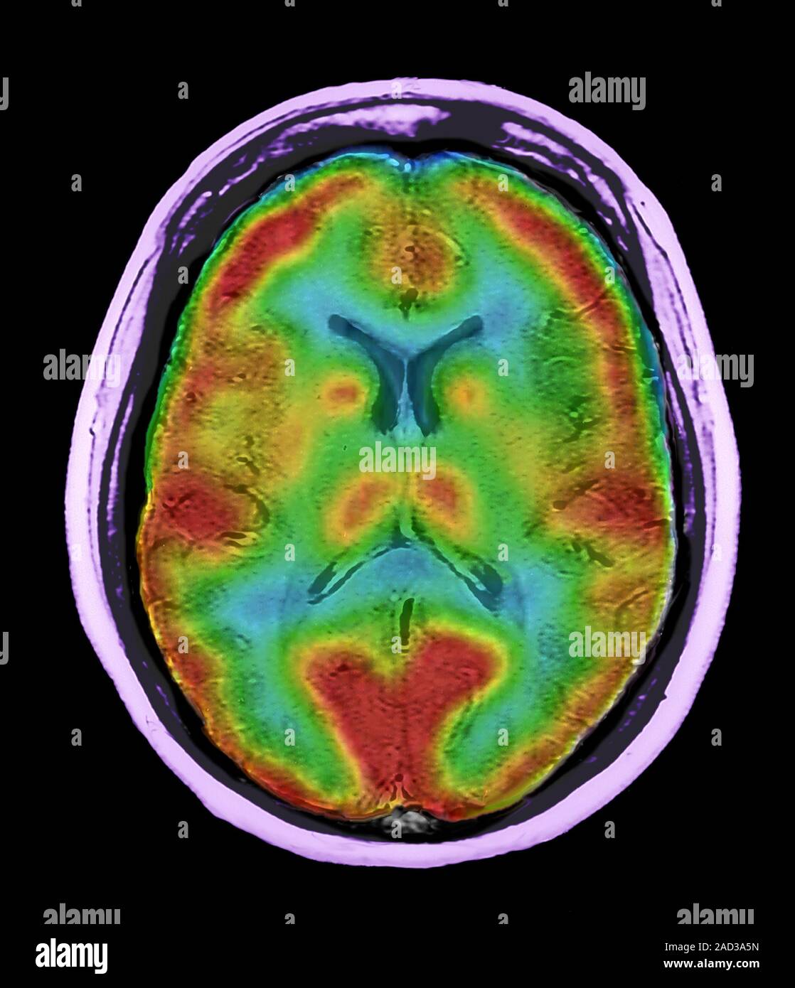 Normal brain blood flow. Composite coloured magnetic resonance imaging ...