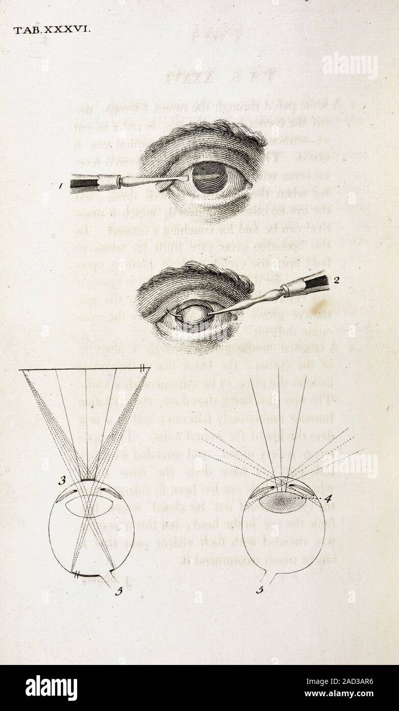 Eye surgery. 18th-century illustration of surgery on human eyes. At top ...