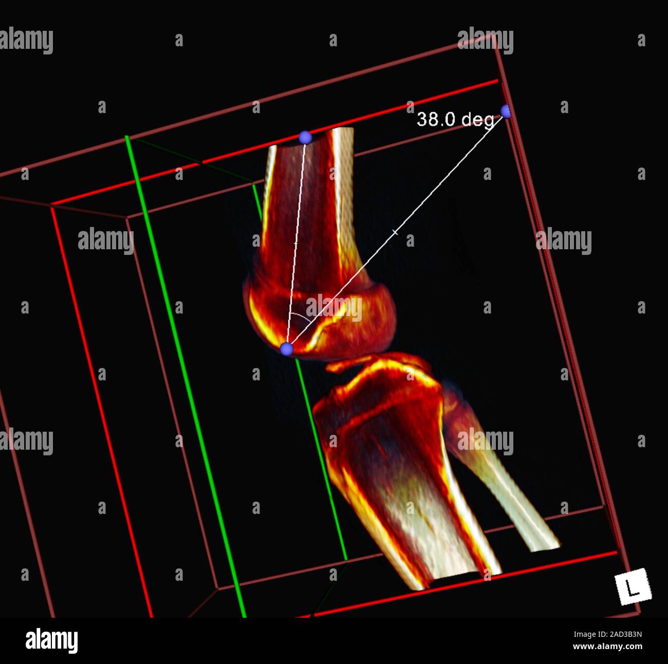 Knee ligament surgery. 3D computed tomography (CT) scan of a knee being ...