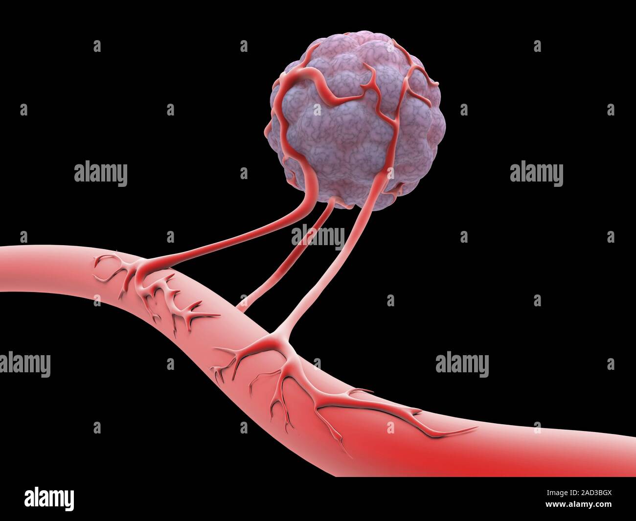 Blood vessel formation. Artwork showing malignant (cancerous) tumour ...