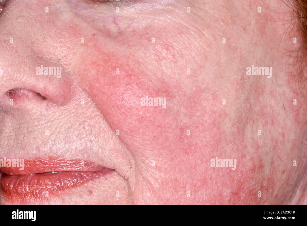 Erysipelas. Close-up of reddened skin on the face of an 80-year-old ...