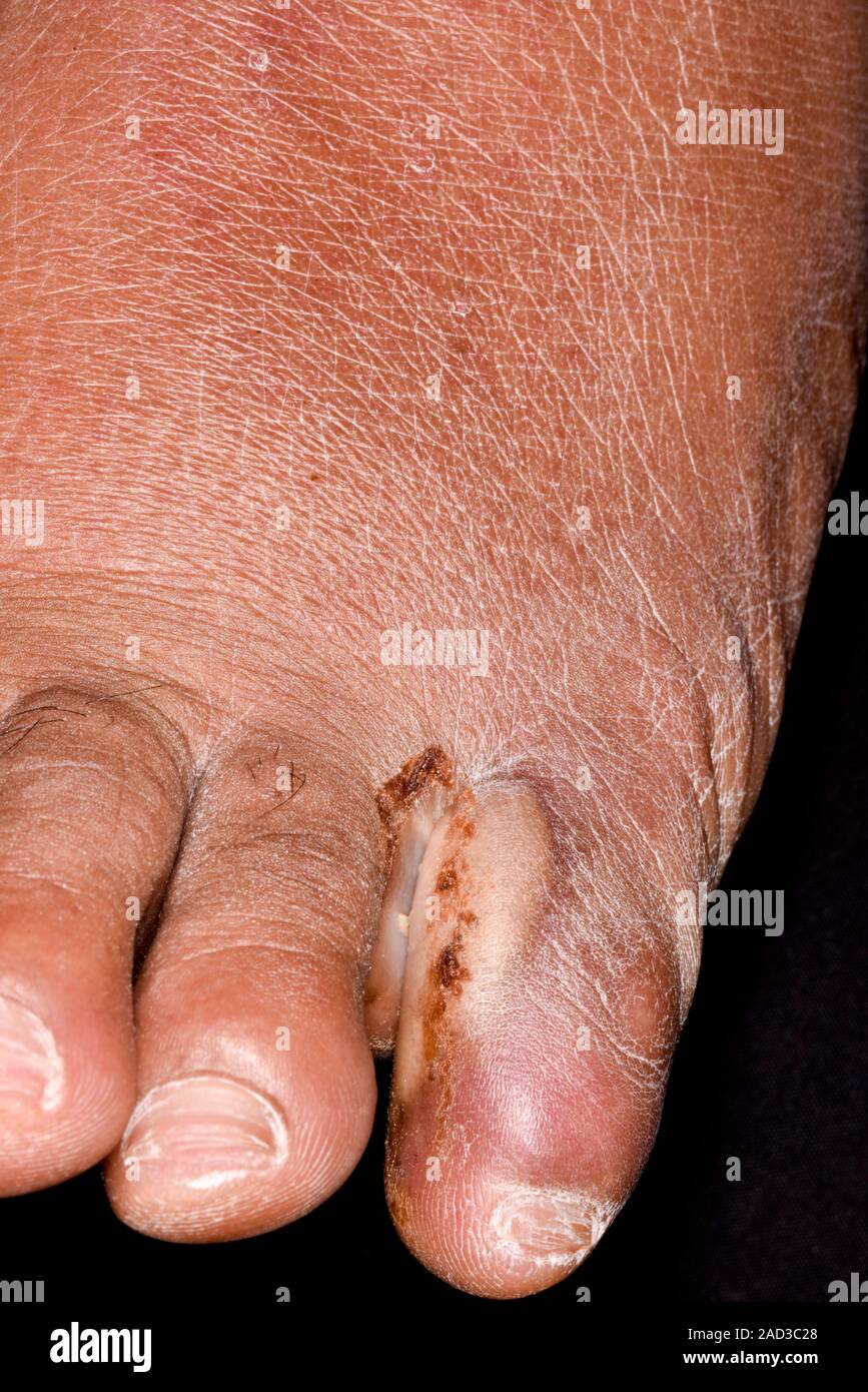 Athlete's foot toe infection in diabetes. Close-up of the infected toe ...