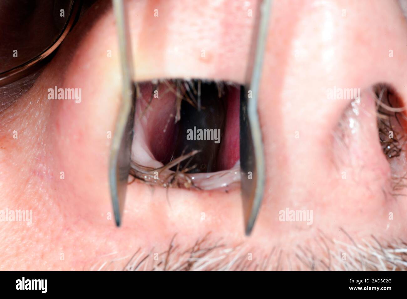 Nasal polyps. Close-up of polyps (white) inside the nostril of a 65 ...