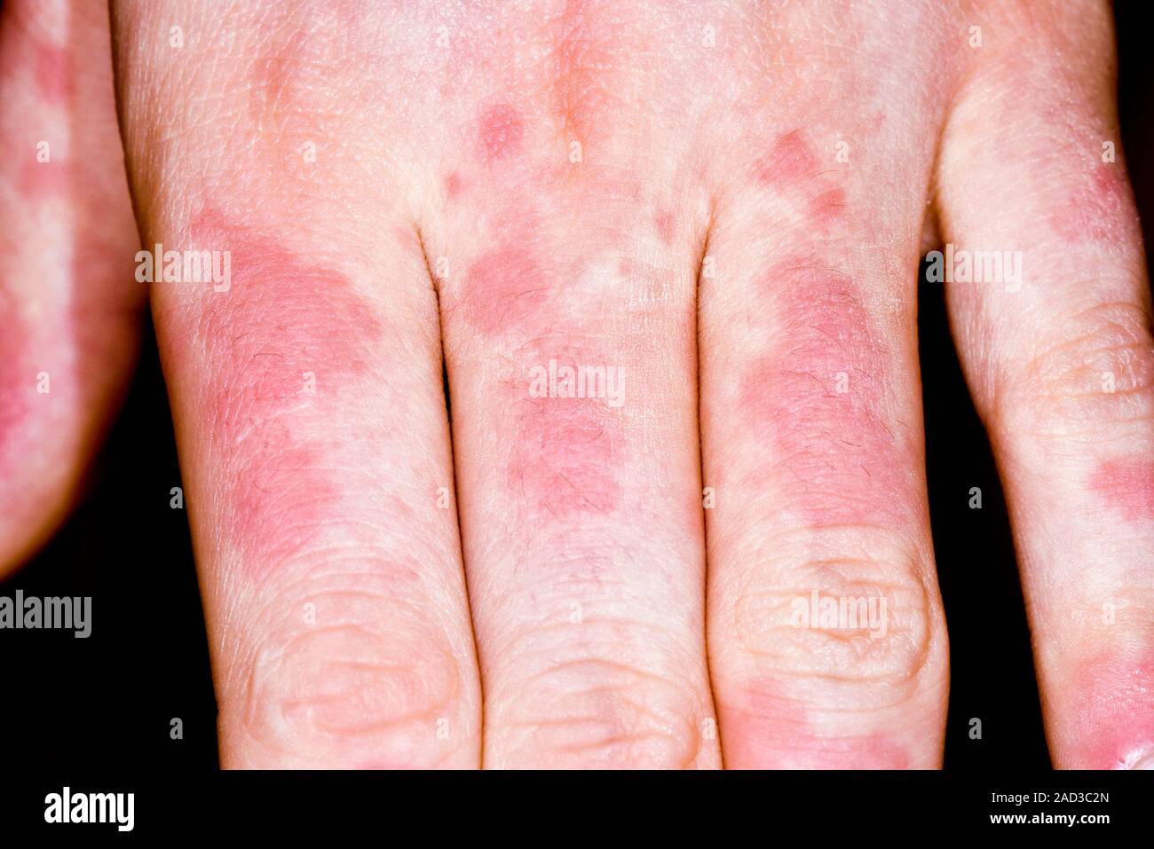 Urticaria. Close-up of urticaria on the hand of a 16-year-old male ...