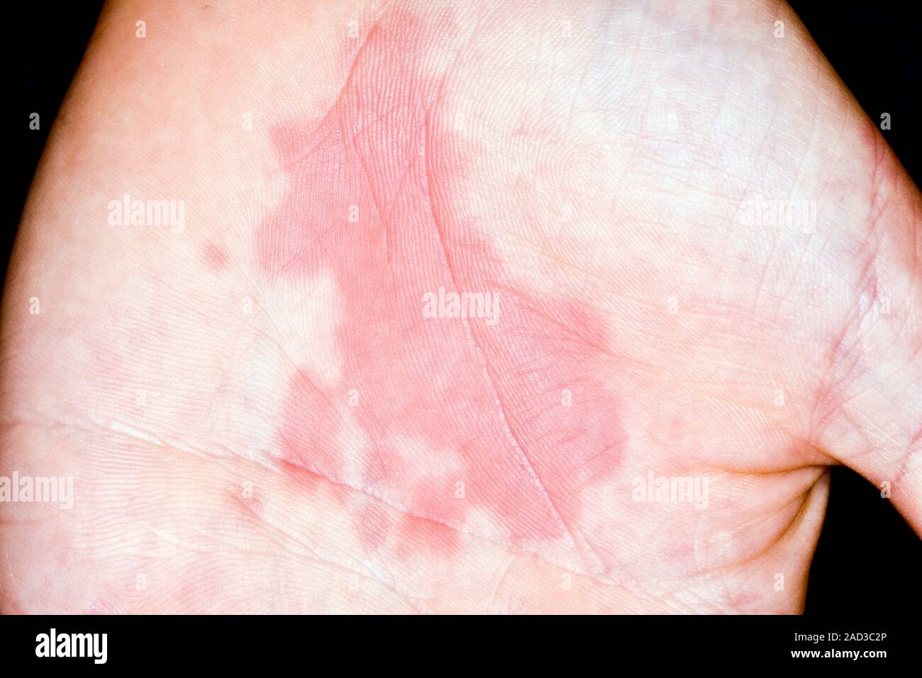 Urticaria. Close-up of urticaria on the palm of a 16-year-old male ...