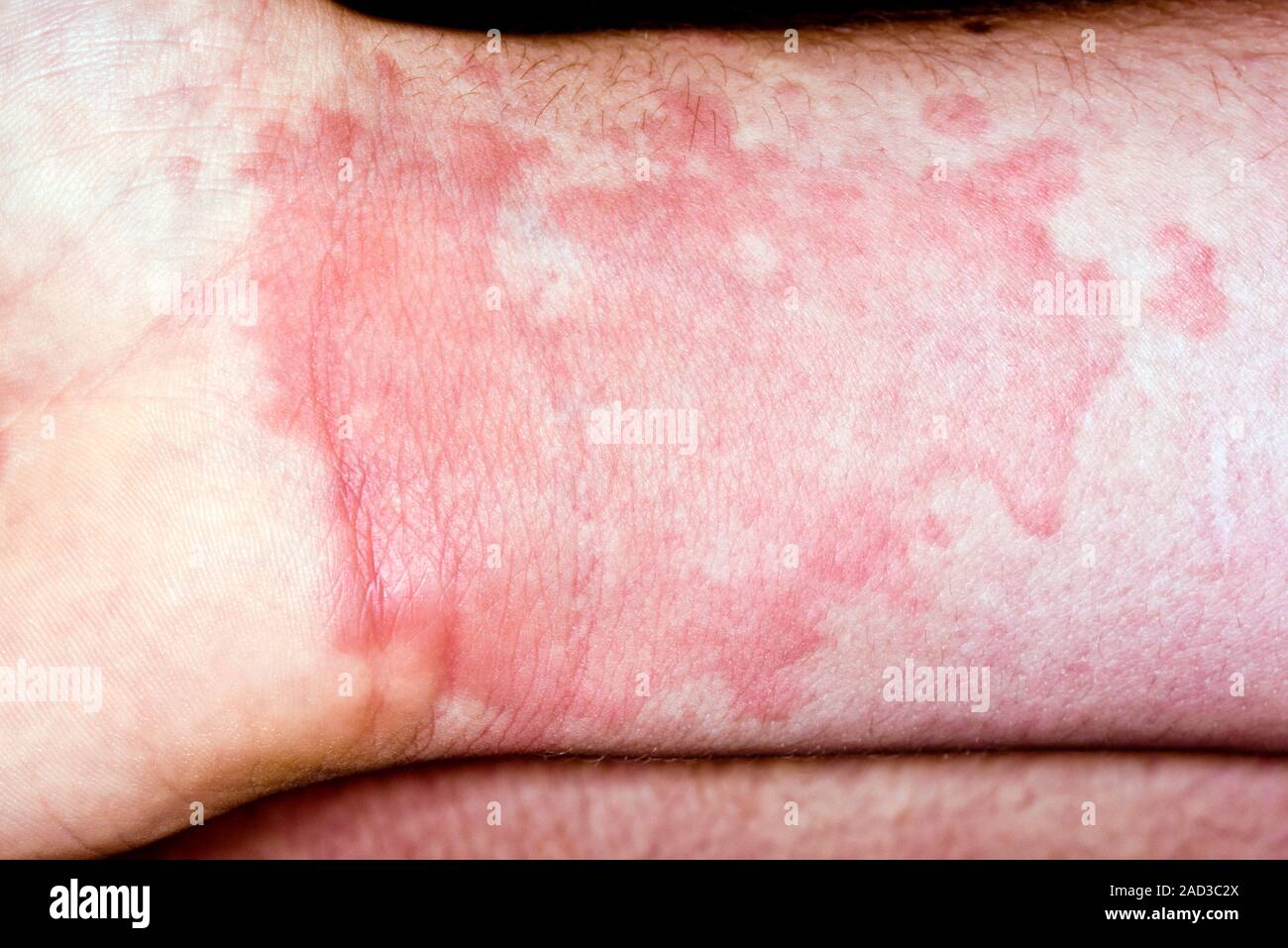 Urticaria. Close-up of urticaria on the wrist of a 16-year-old male ...