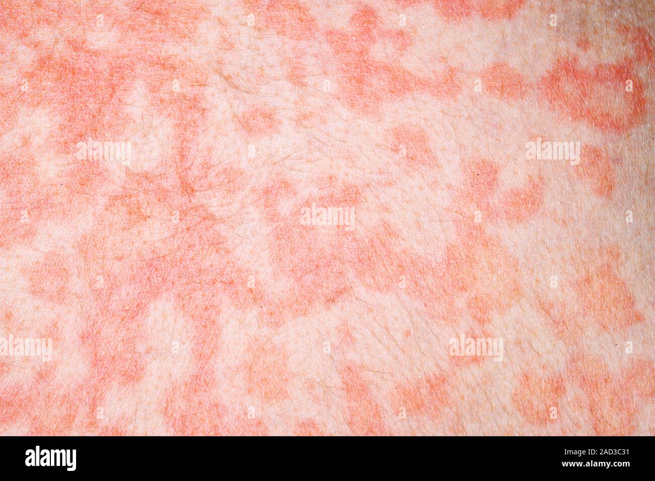 Urticaria. Close-up of urticaria on a 10-year-old male patient ...
