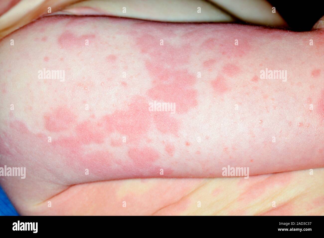 Urticaria. Close-up of urticaria (red) on the arm of a 1-year-old male ...