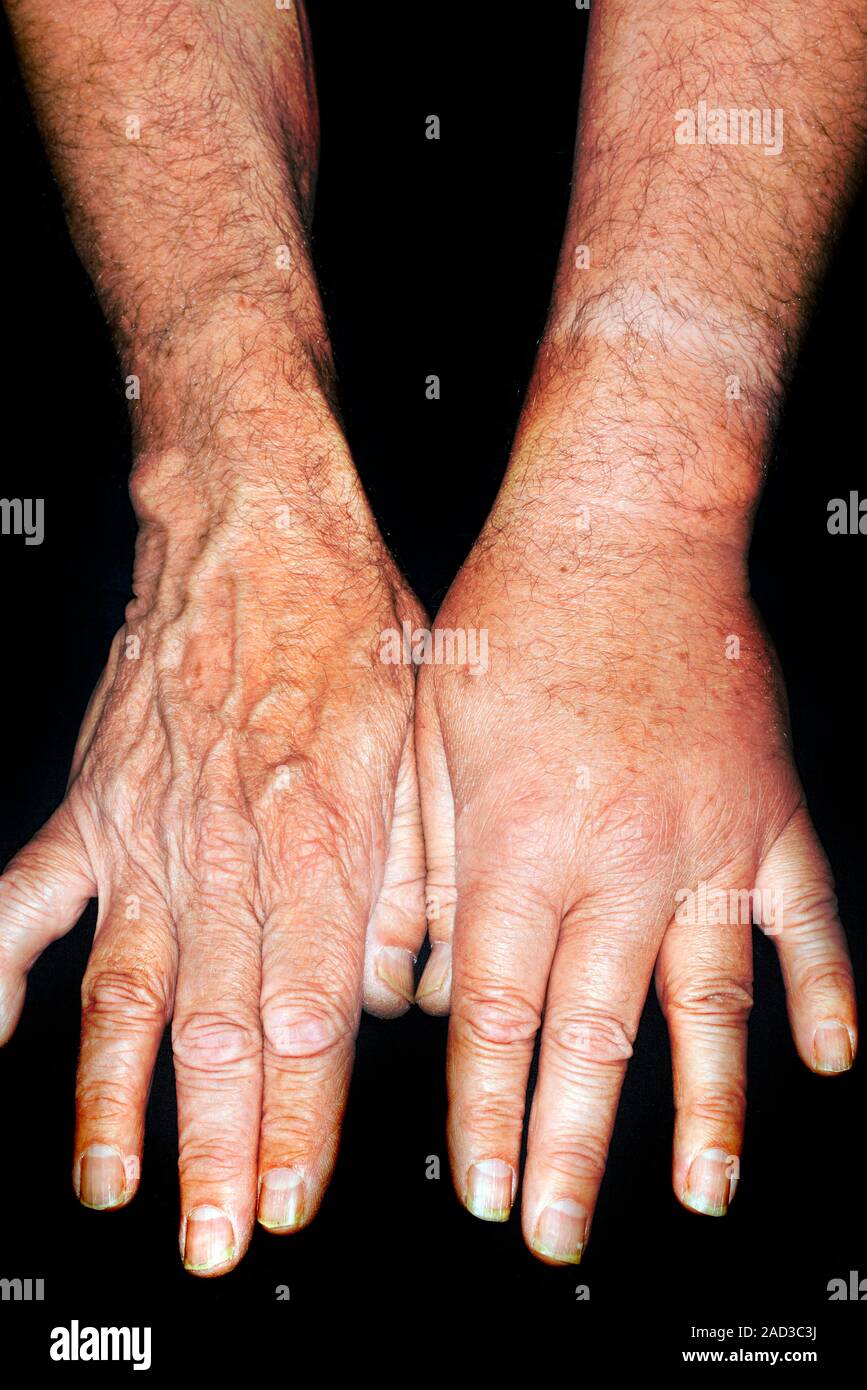 Allergic reaction to wasp sting. Close-up of the hands of a 76-year-old ...