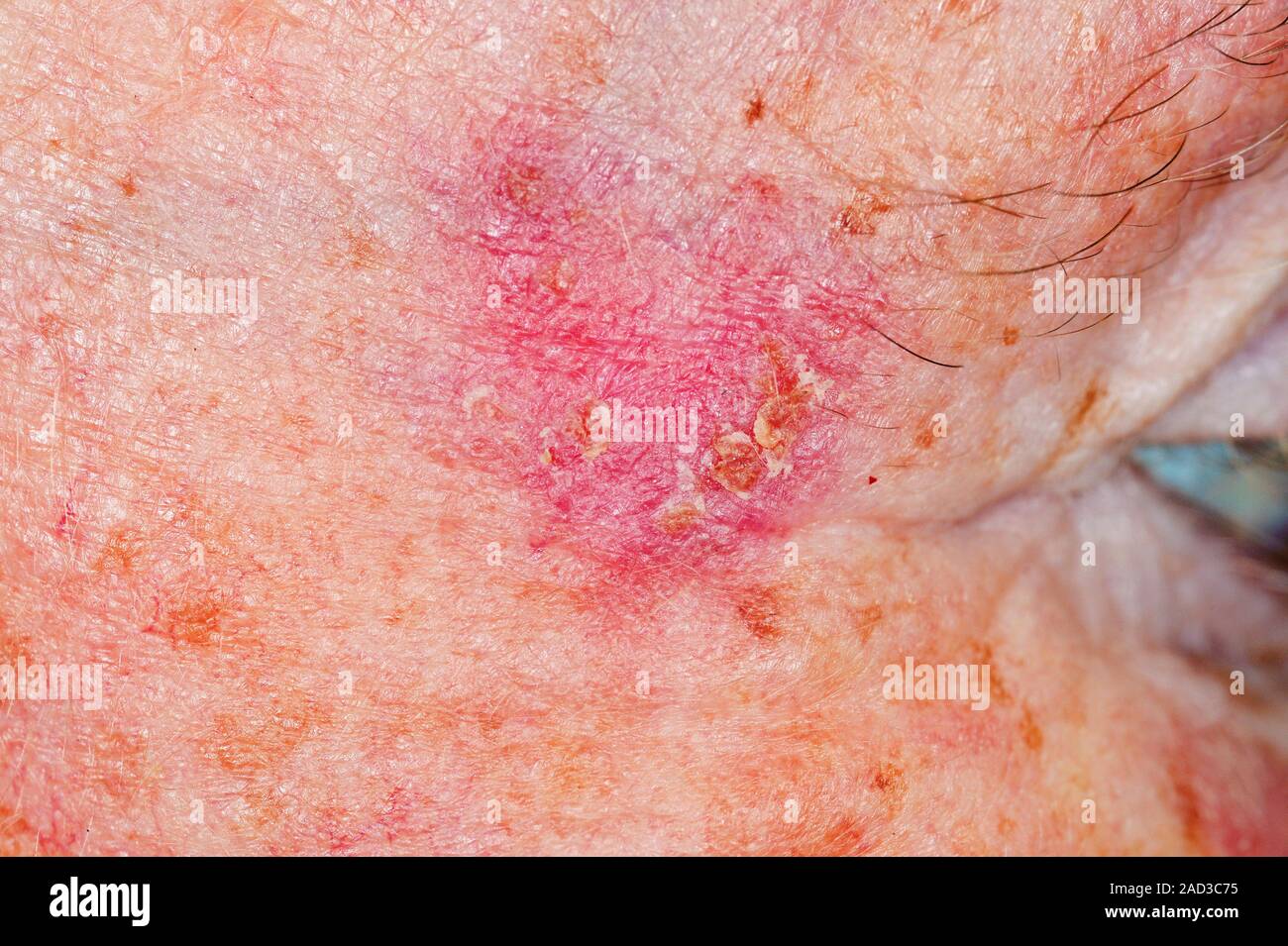 Solar keratosis. Close-up of the skin of a 70-year-old male patient ...