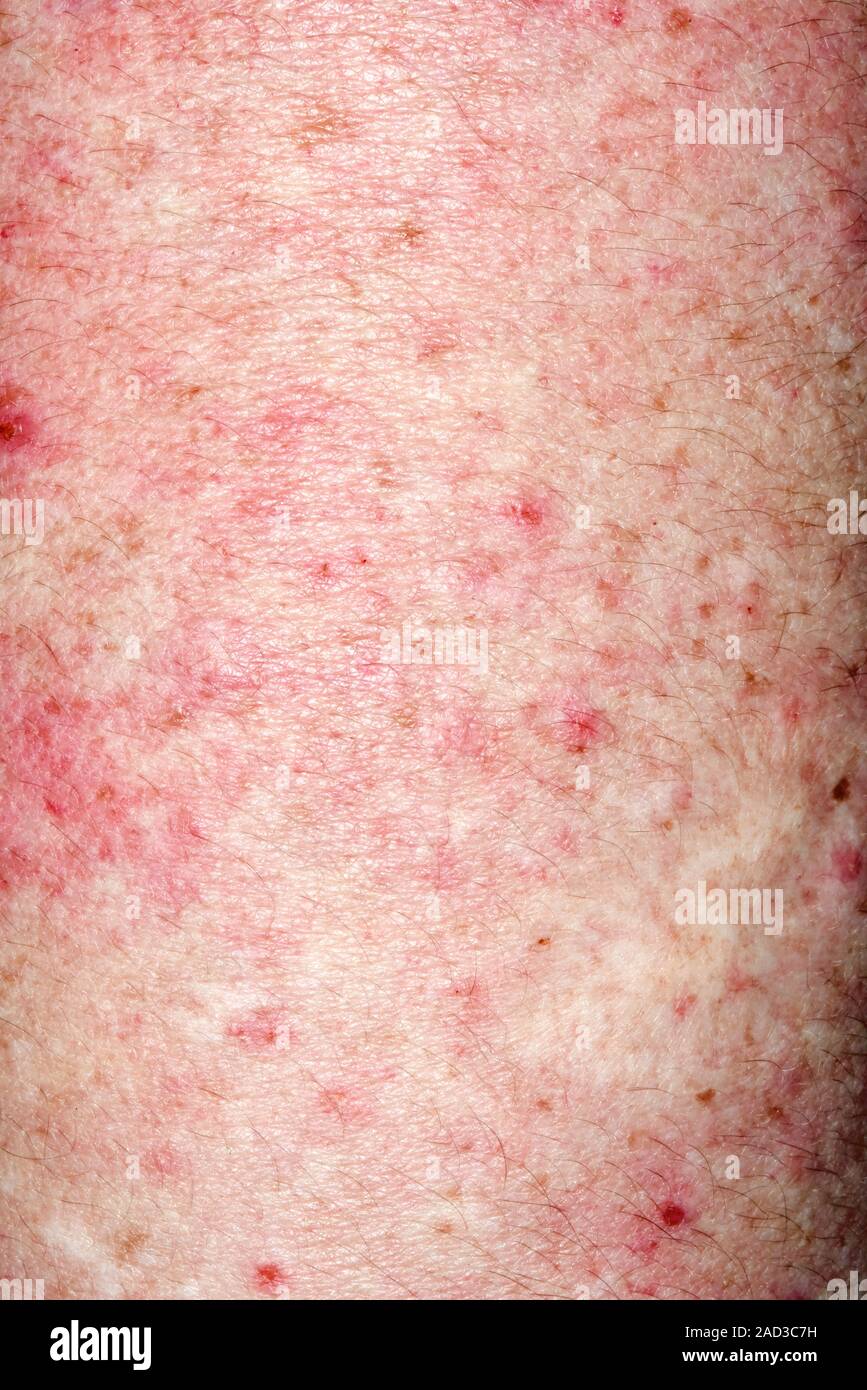 Rash after steroid use. Close-up of a rash on the skin of a 52-year-old ...