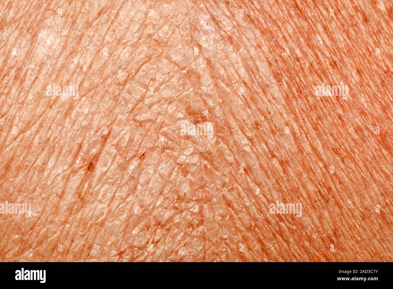 Lichen sclerosis. Close-up of lichen sclerosis on the body of a 57-year ...