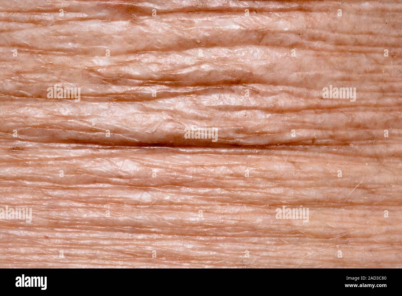 Lichen sclerosis. Close-up of lichen sclerosis on the body of a 57-year ...