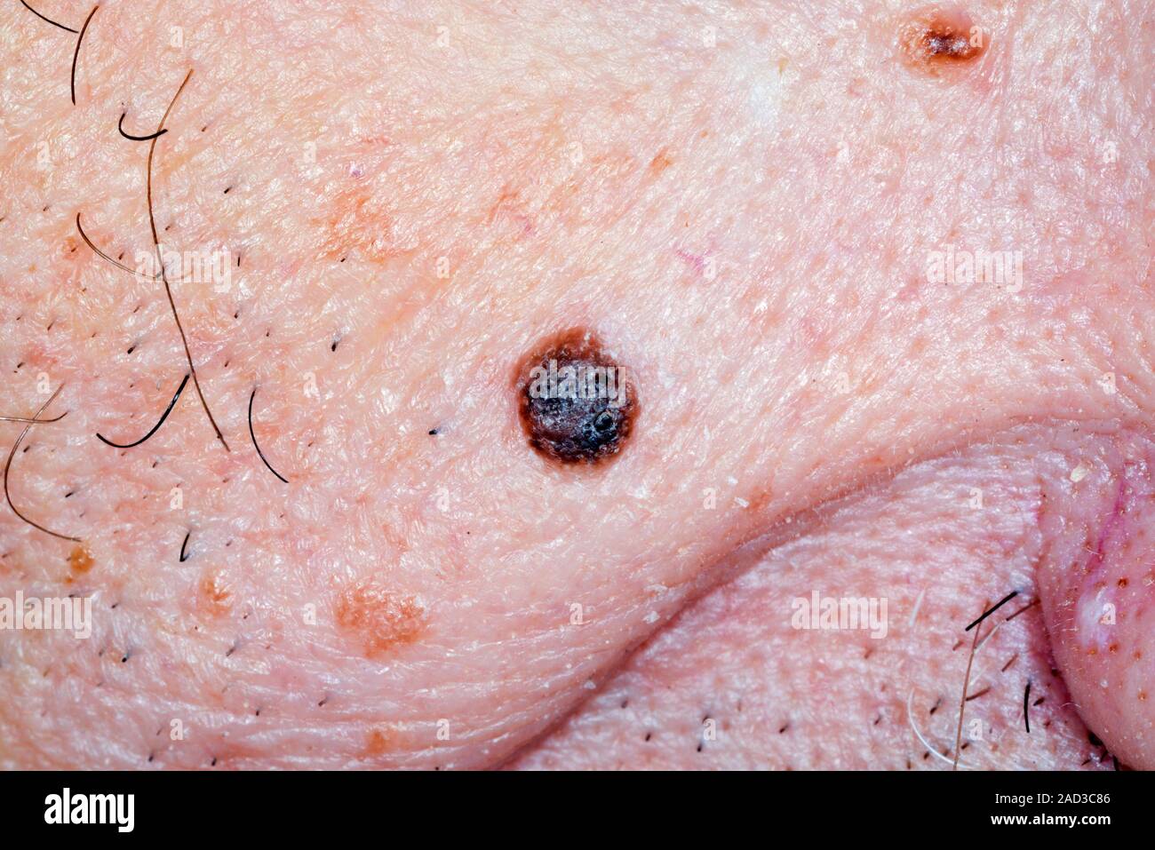 Seborrheic keratosis. Close-up of a pigmented seborrheic keratosis ...