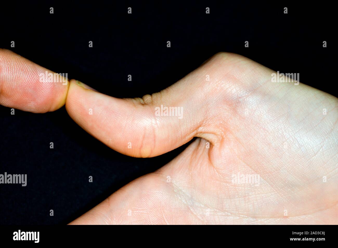 Hypermobile thumb. Close-up of the hand (centre) of a 13-year-old male ...