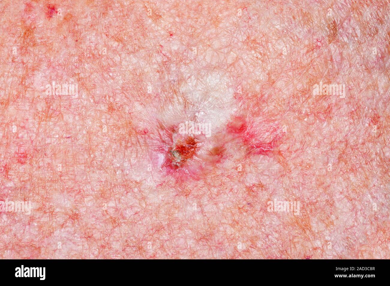 Skin cancer. Close-up of basal cell carcinoma (skin cancer) on the ...