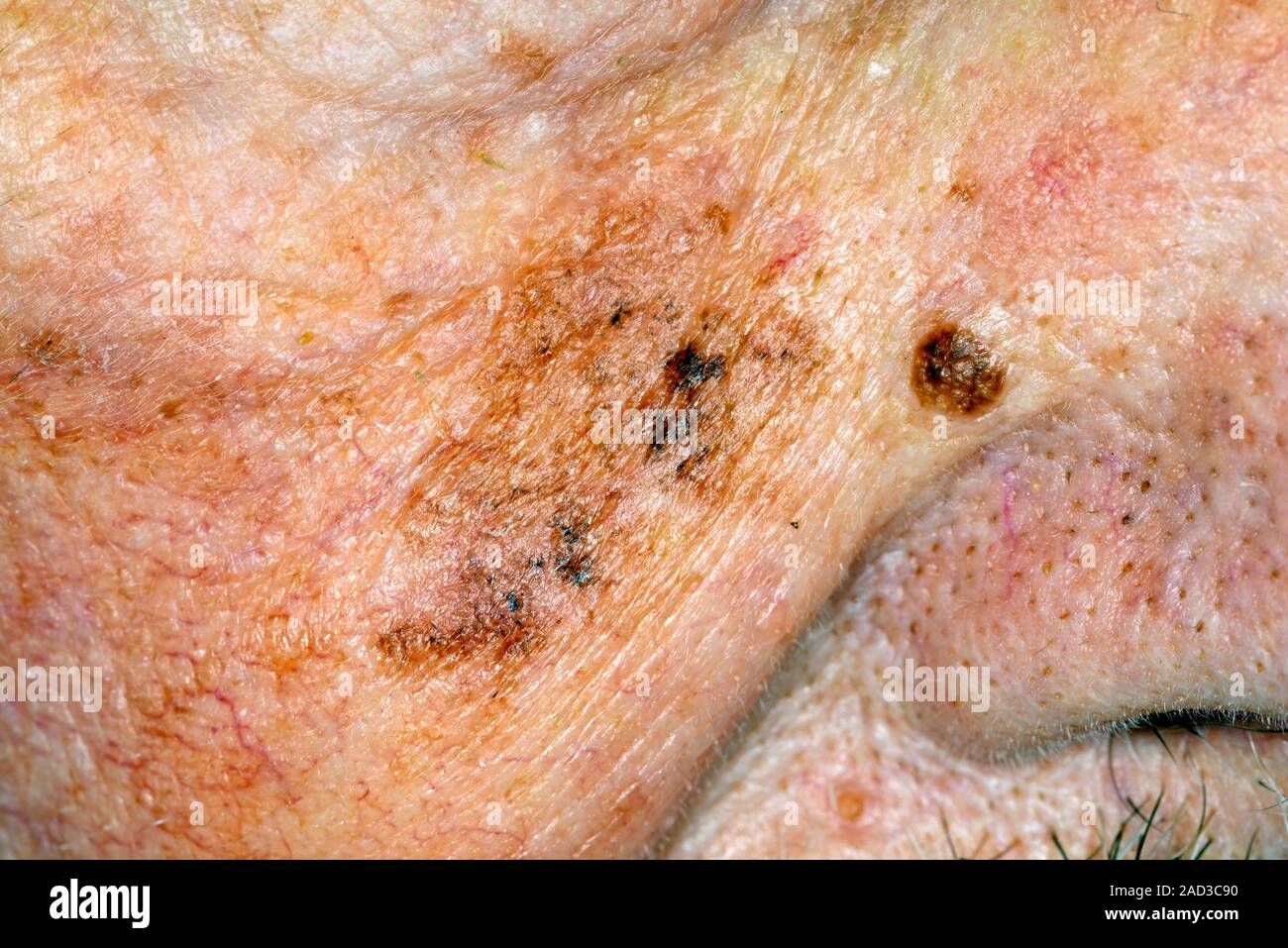 Lentigo maligna. Close-up of lentigo maligna on the cheek of a 92-year ...