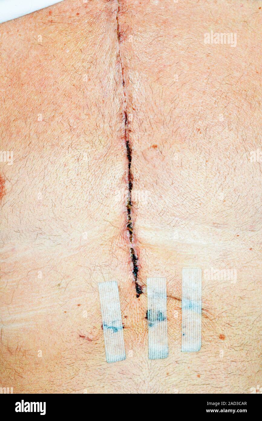 Heart bypass surgery scar. Close-up of a surgical scar on the chest of ...